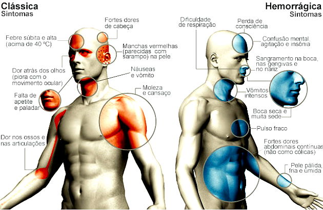 Dengue: sintomas, transmissão e tratamento - Toda Matéria